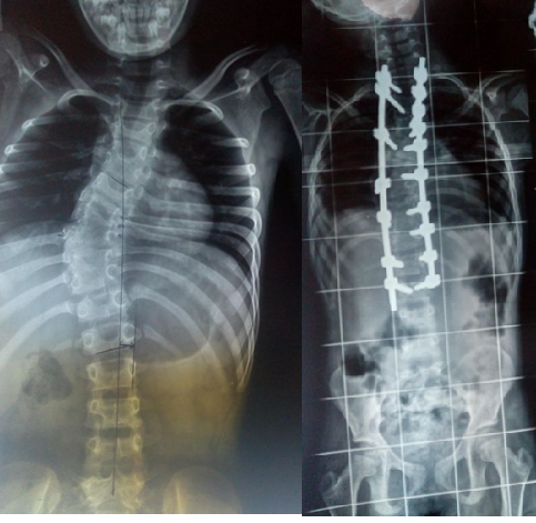 Spinal Deformity Correction | Dr. Ajay Kothari - Spine Surgeon